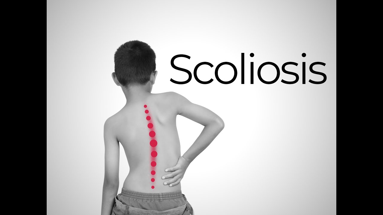 What is Scoliosis? - Health Journal